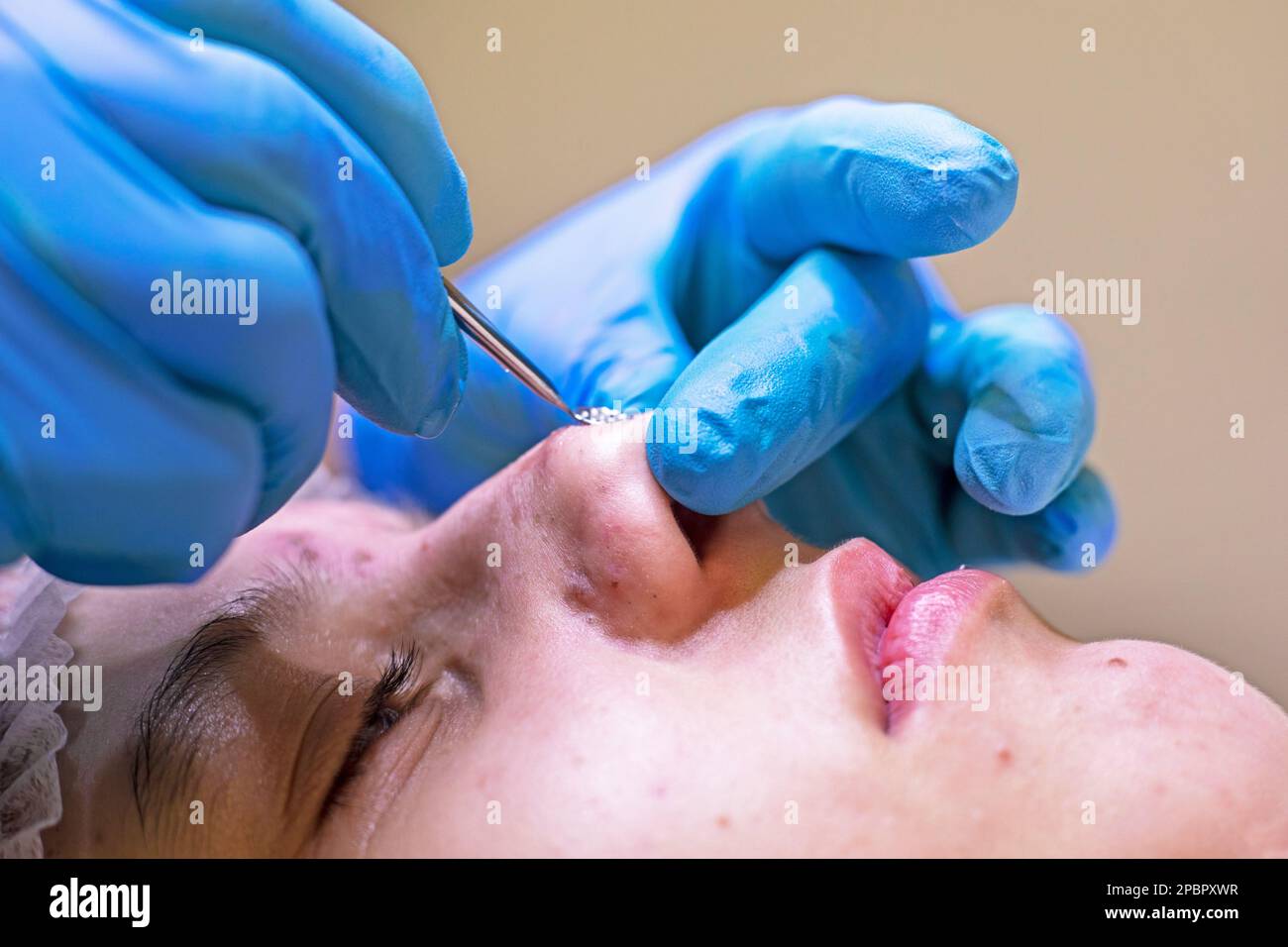 cosmetologist removes black dots from the nose with a special tool ...