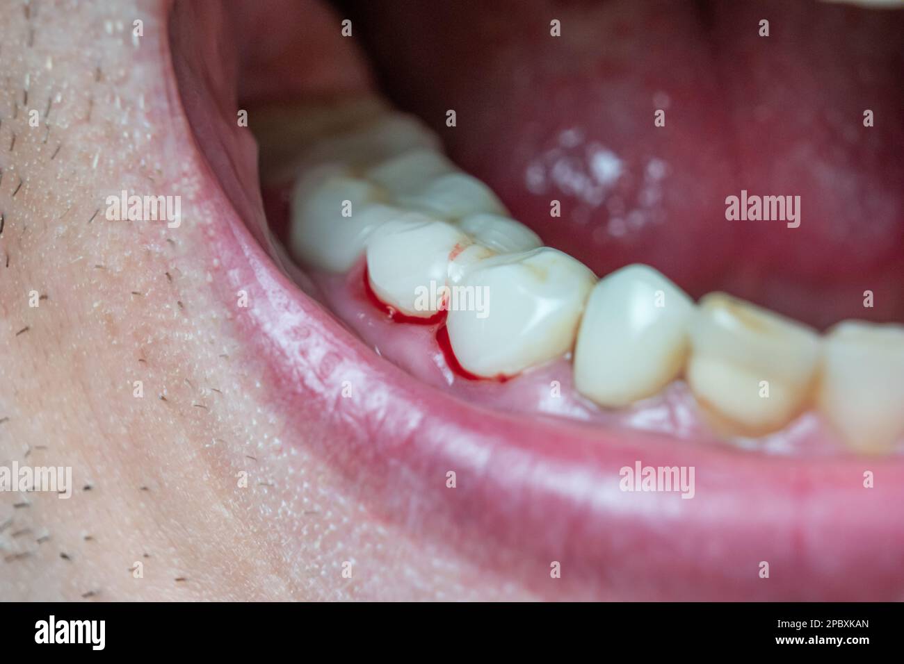 Caucasian male open mouth showing bleeding gums and a row of white ...