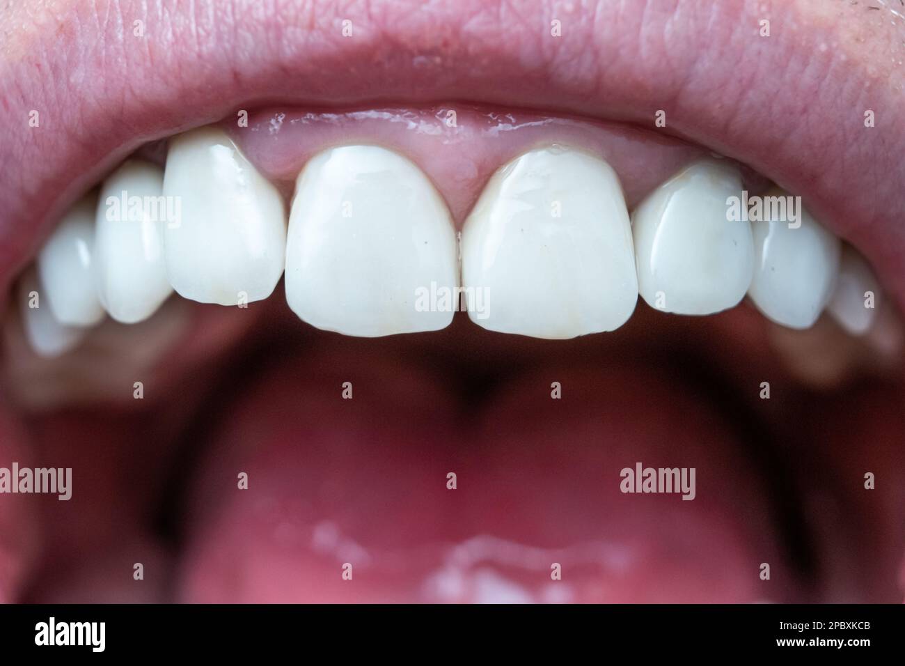 Caucasian male open mouth showing row of white teeth and back of the ...