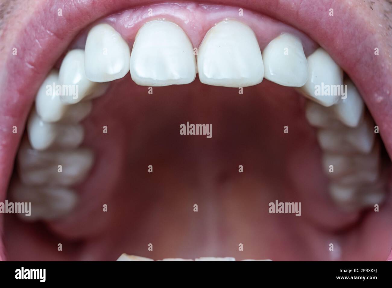 Caucasian male open mouth showing row of white teeth and back of the ...