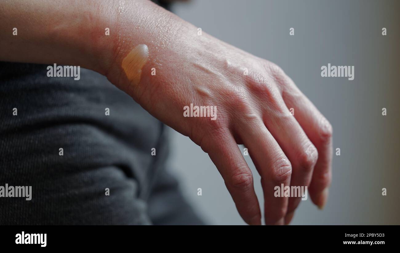 Close-up of a woman's hand with a blister from a boiled water burn ...