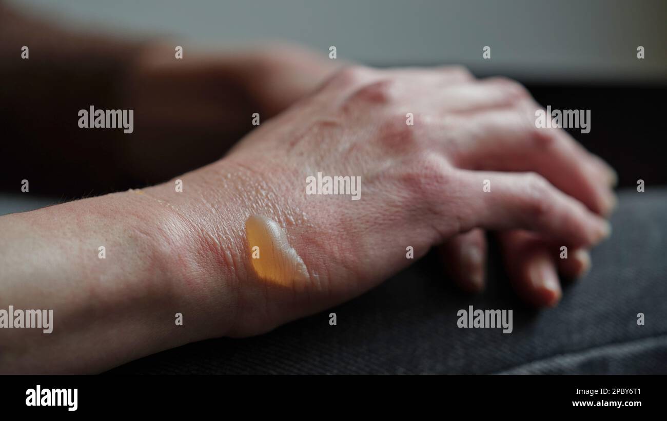 Close-up of a woman's hand with a blister from a boiled water burn ...