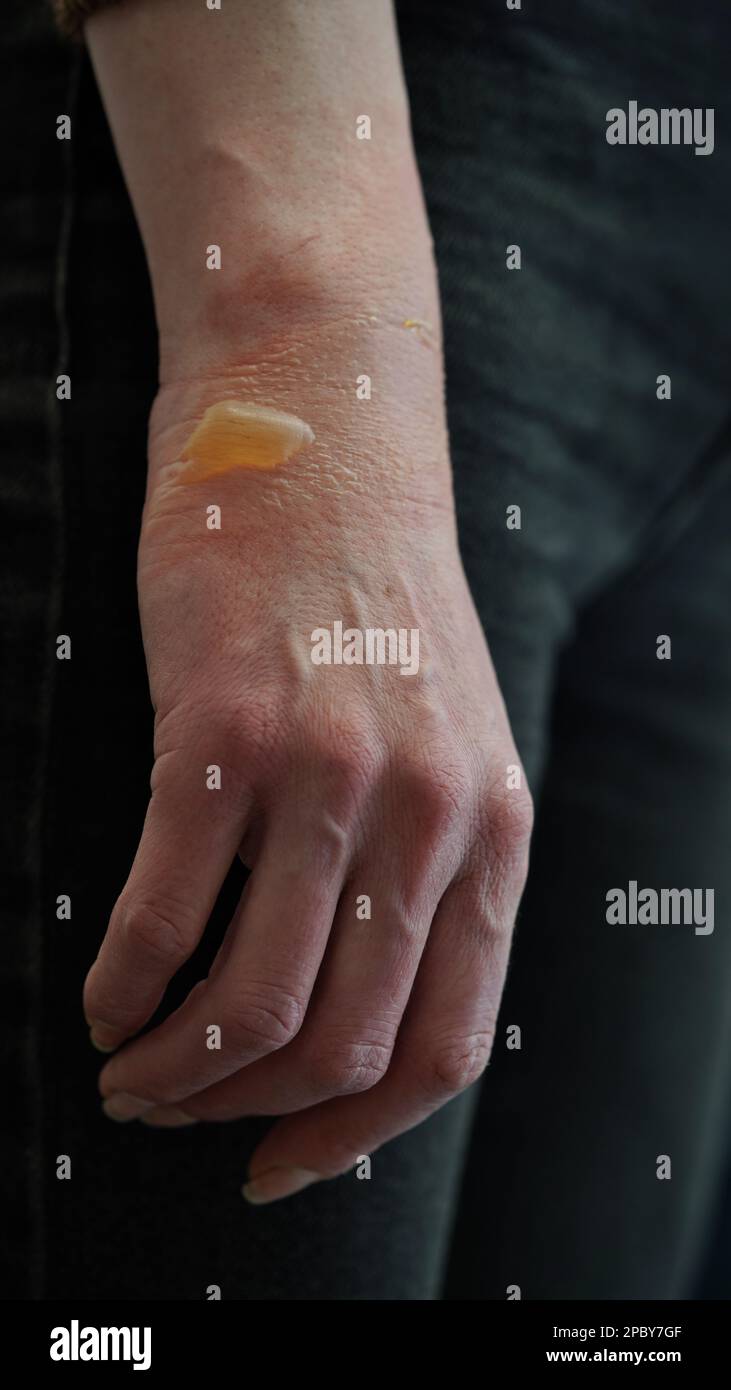 Close-up of a woman's hand with a blister from a boiled water burn ...