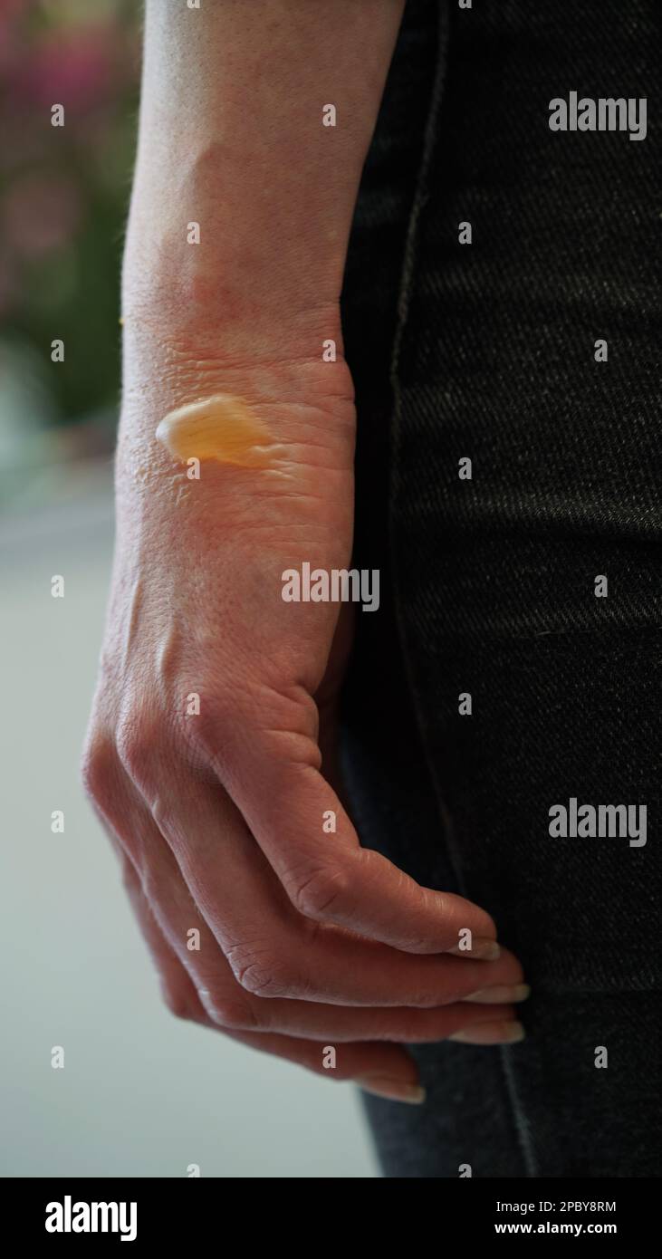 Close-up of a woman's hand with a blister from a boiled water burn ...