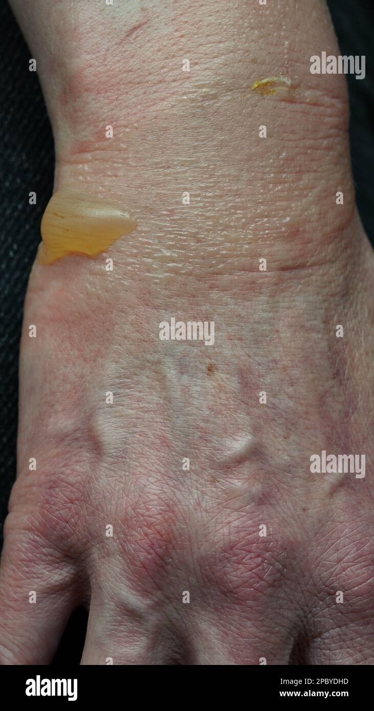 Close-up of a woman's hand with a blister from a boiled water burn ...