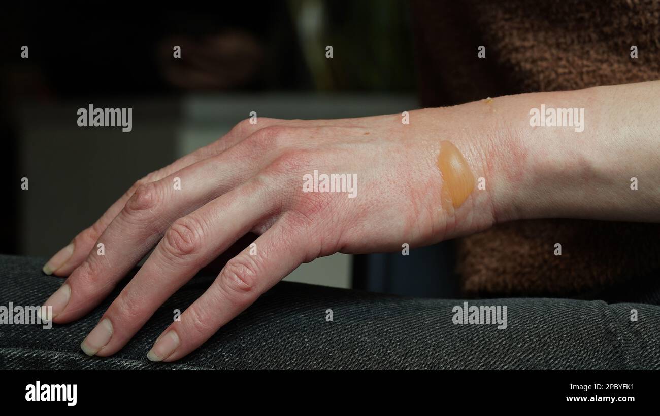 Close-up of a woman's hand with a blister from a boiled water burn ...