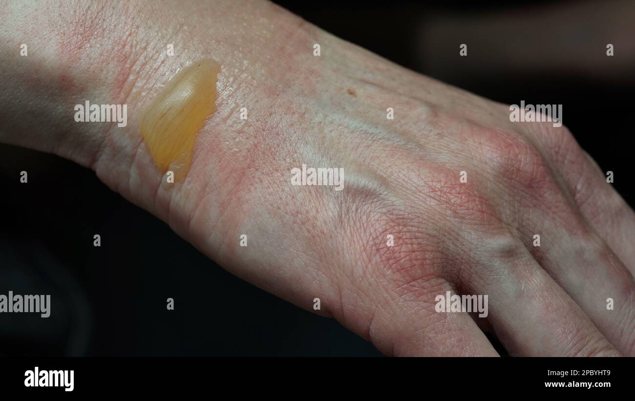 Close-up of a woman's hand with a blister from a boiled water burn ...