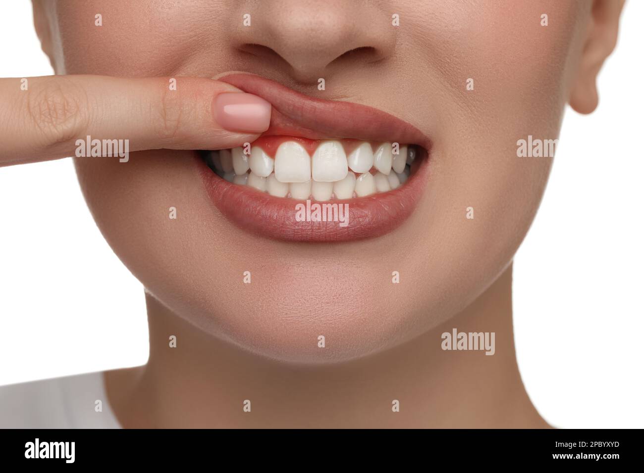 Inflamed gums hi-res stock photography and images - Alamy