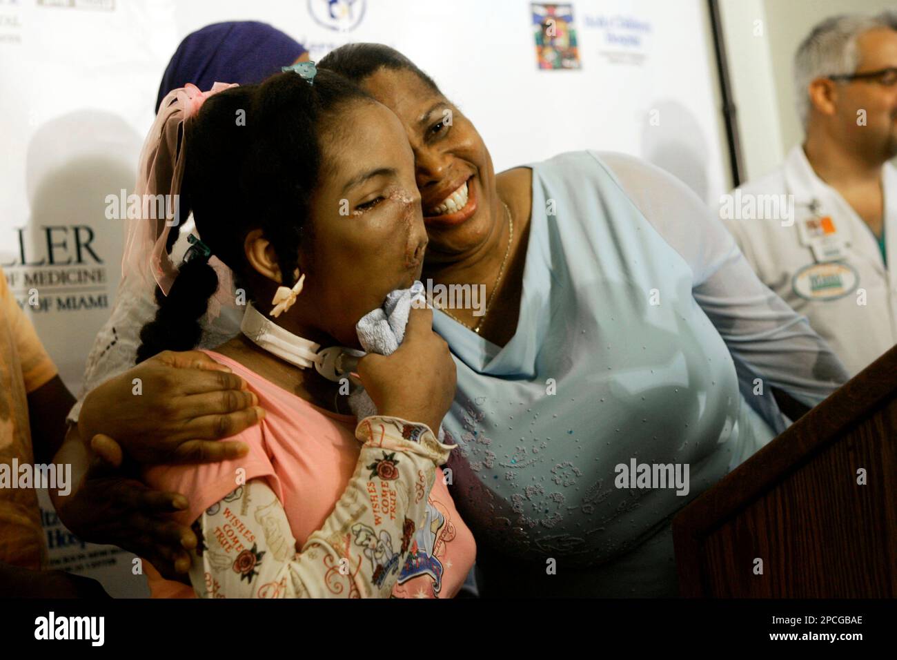 Fibrous Dysplasia Marlie