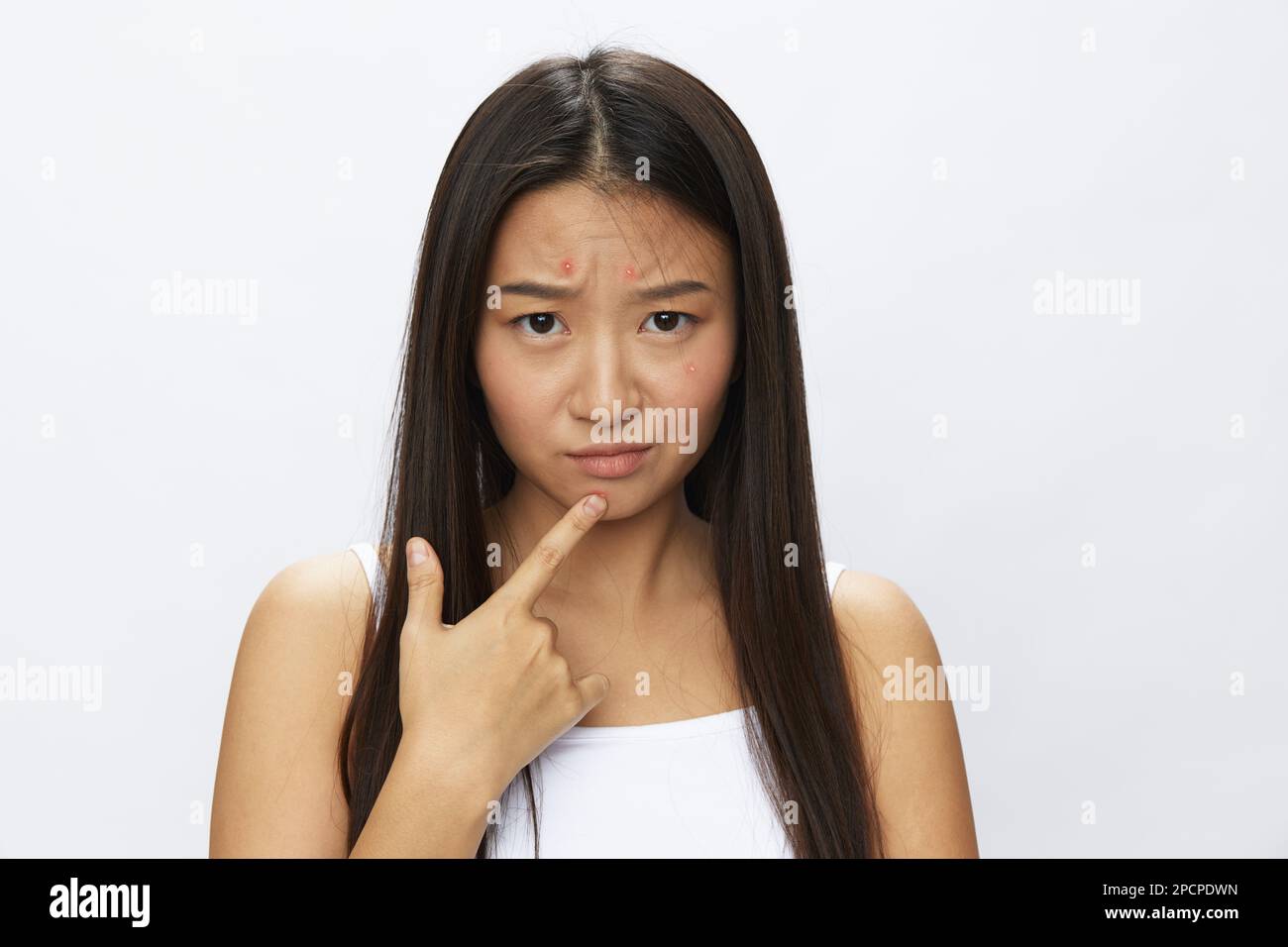 Asian woman facial skin problems, acne and inflammation, red rashes and ...