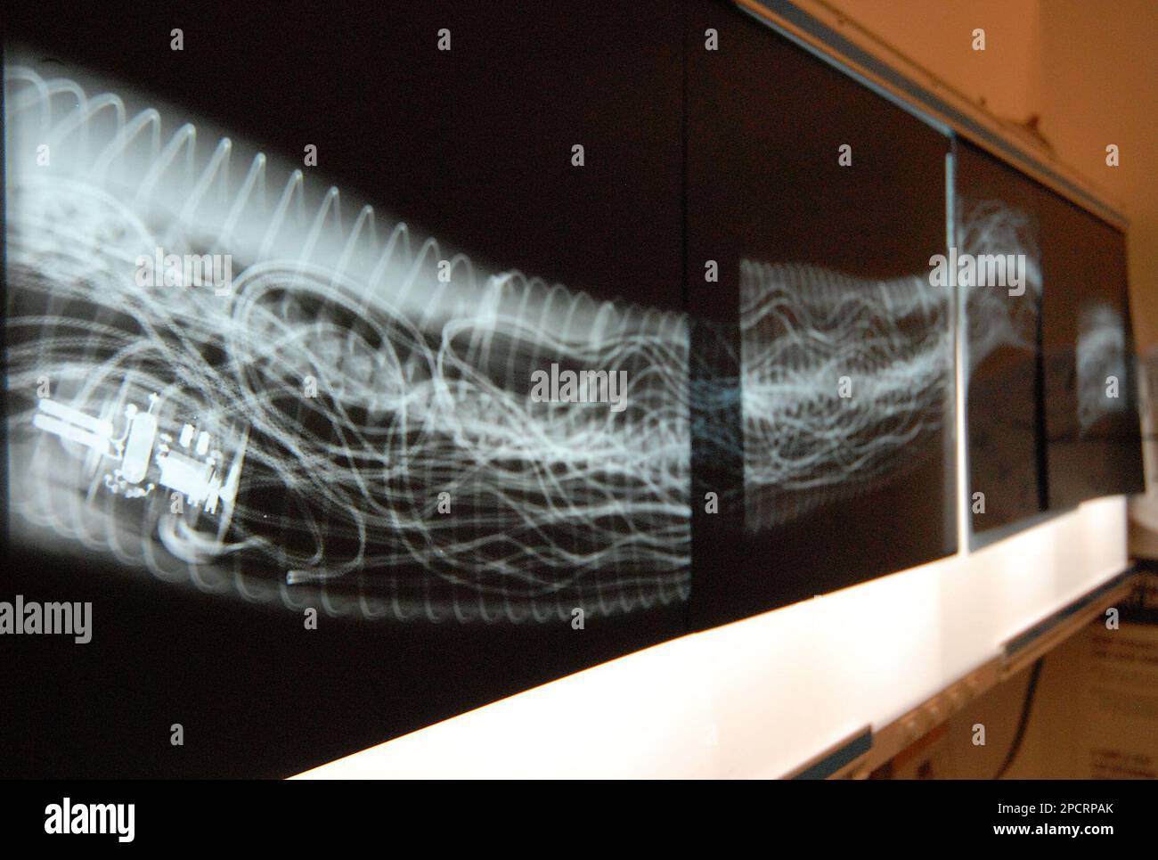 Pre-surgery X-rays of Houdini, a 12-foot (3.6-meter) Burmese python ...