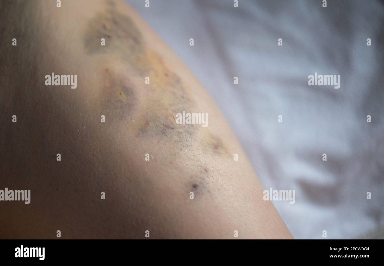 Bruises on the skin of the patient's leg after intramuscular injections ...