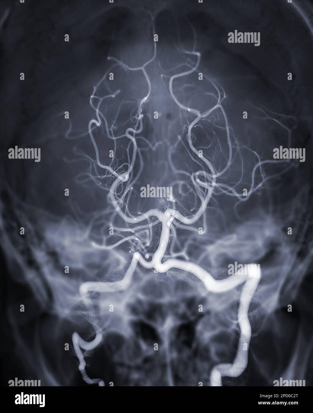 Cerebral angiography imageor potesterior cerebral artery from ...