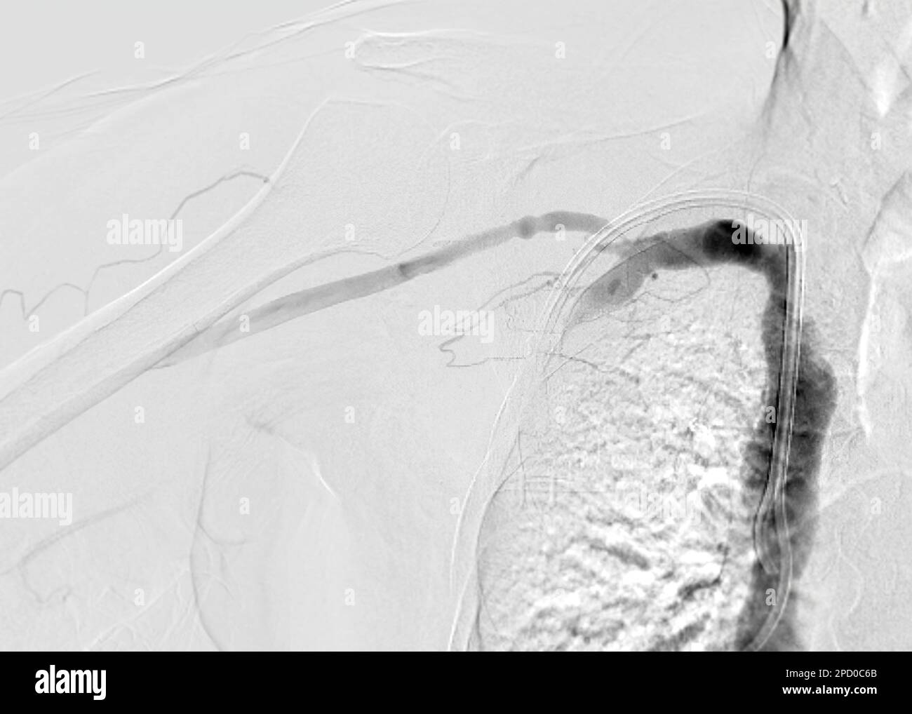 Image of Angioplasty, balloon angioplasty and percutaneous transluminal ...