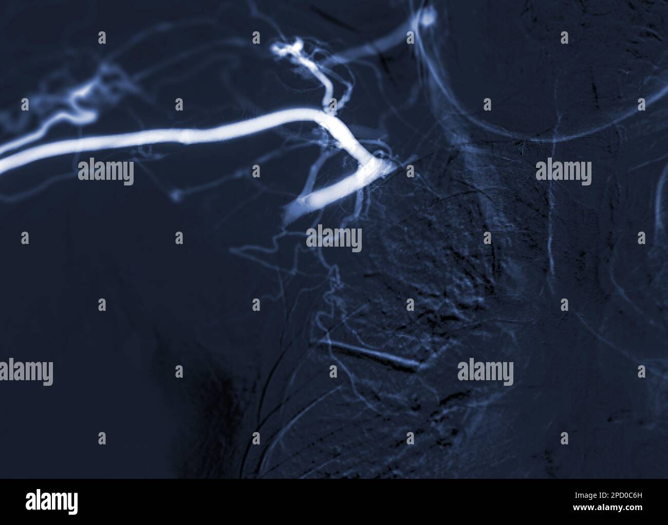 Image of Angioplasty, balloon angioplasty and percutaneous transluminal ...
