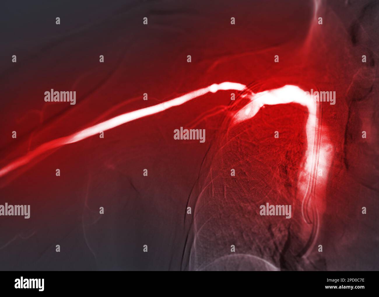 Image of Angioplasty, balloon angioplasty and percutaneous transluminal ...