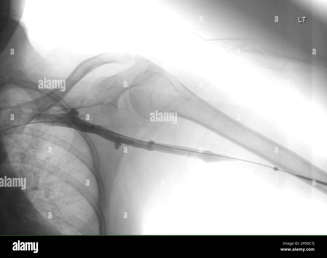 Image of Angioplasty, balloon angioplasty and percutaneous transluminal ...