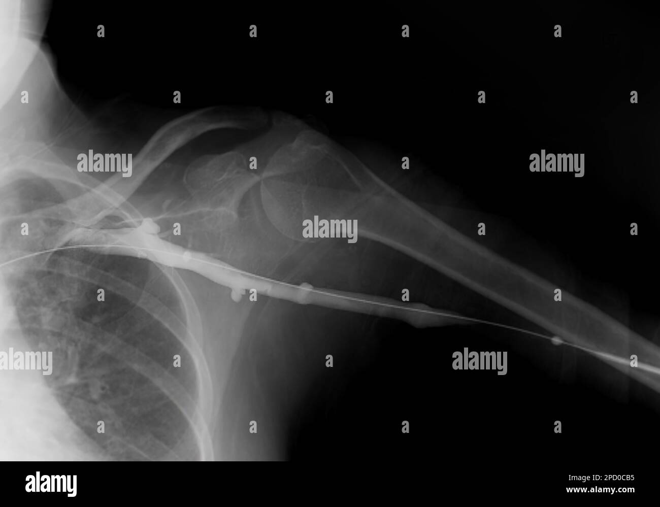 Image of Angioplasty, balloon angioplasty and percutaneous transluminal ...
