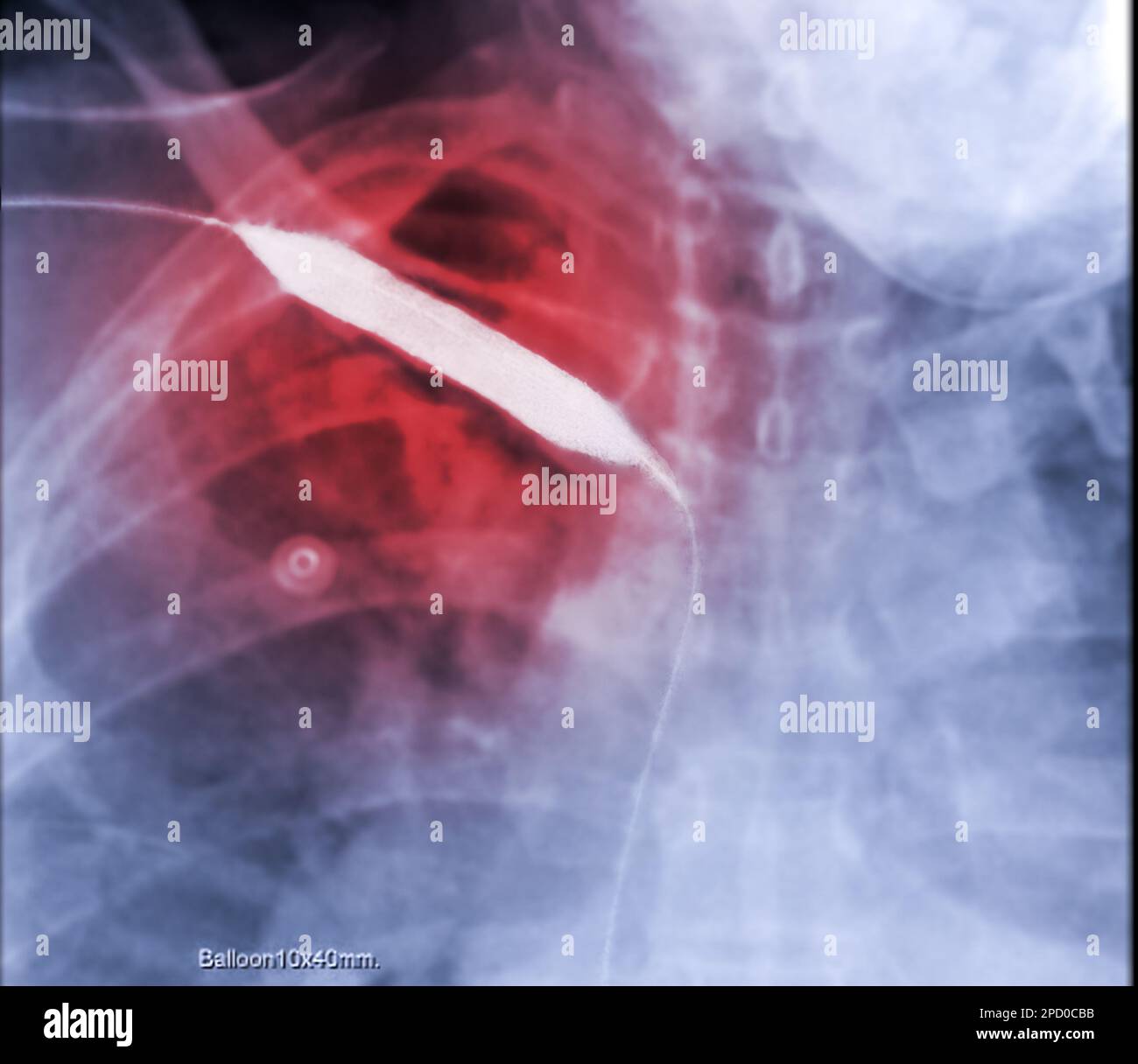 Image of Angioplasty, balloon angioplasty and percutaneous transluminal ...