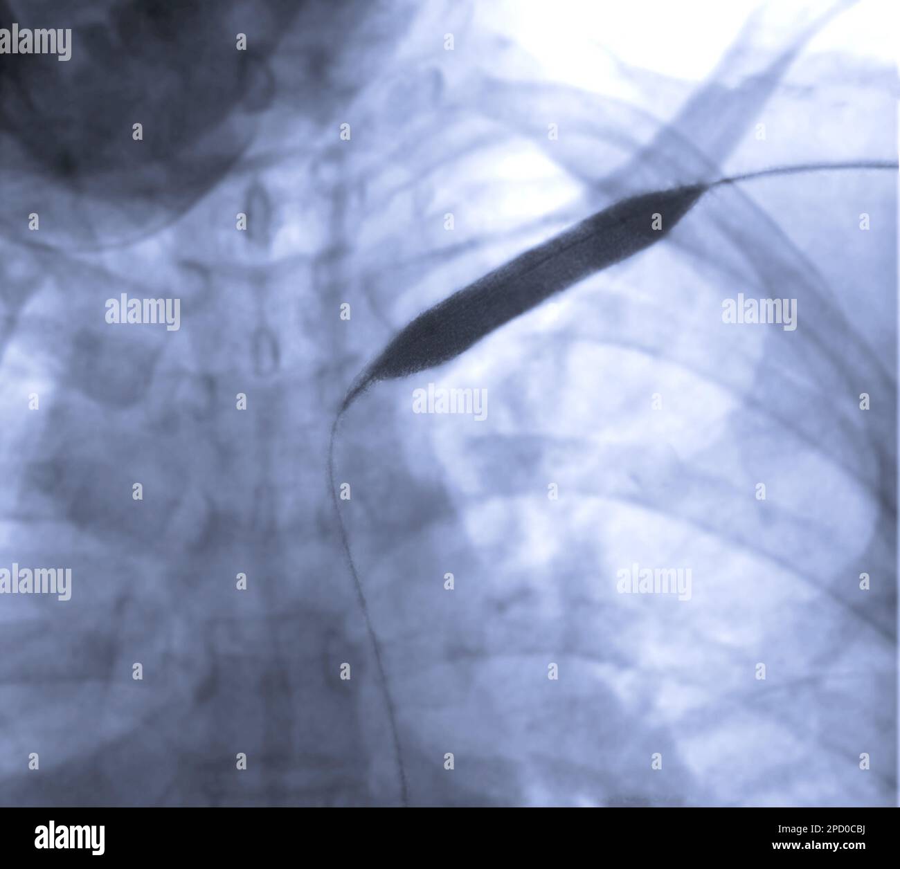 Stent injection hi-res stock photography and images - Alamy