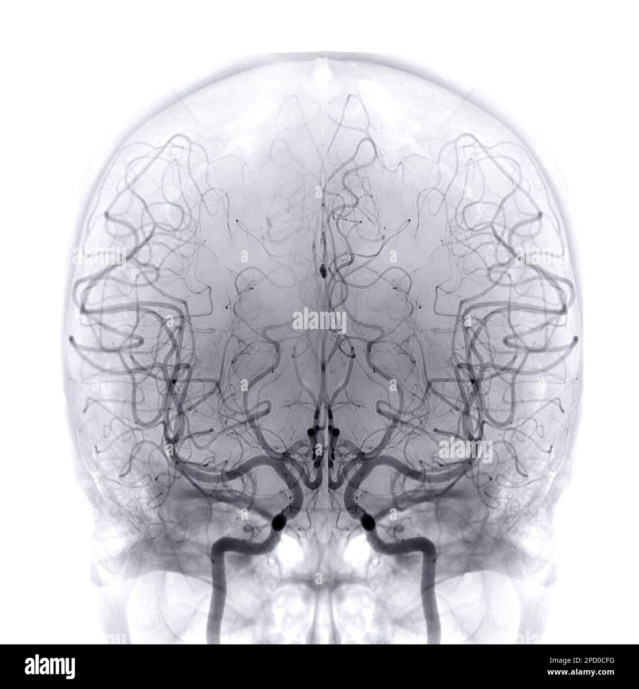 Cerebral angiography image from Fluoroscopy in intervention radiology ...
