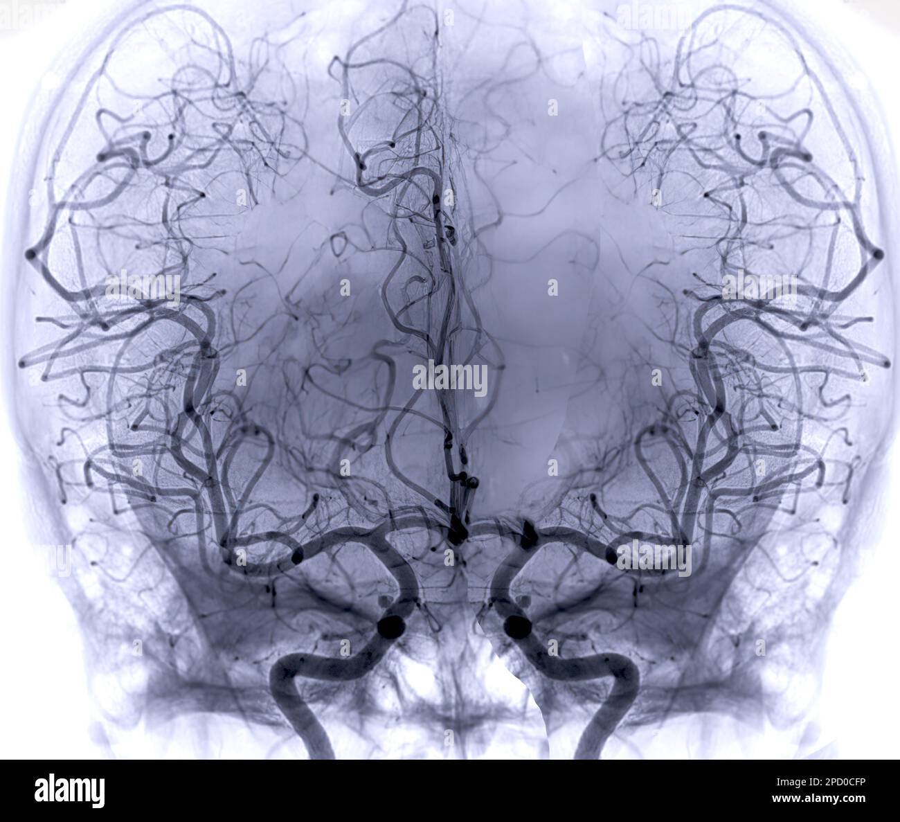 Cerebral angiography image from Fluoroscopy in intervention radiology ...