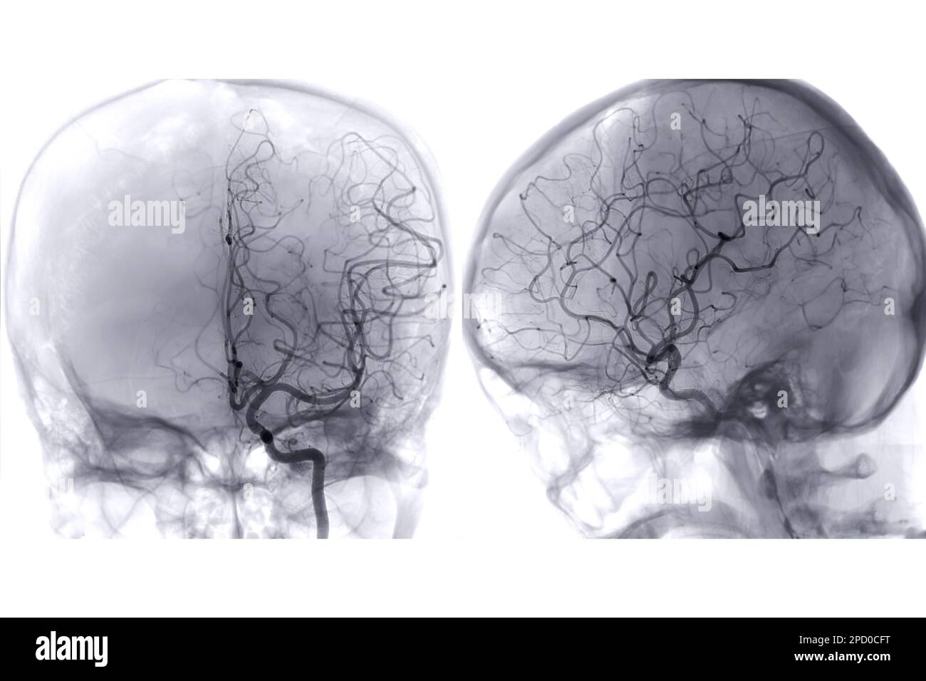 Cerebral angiography image from Fluoroscopy in intervention radiology ...
