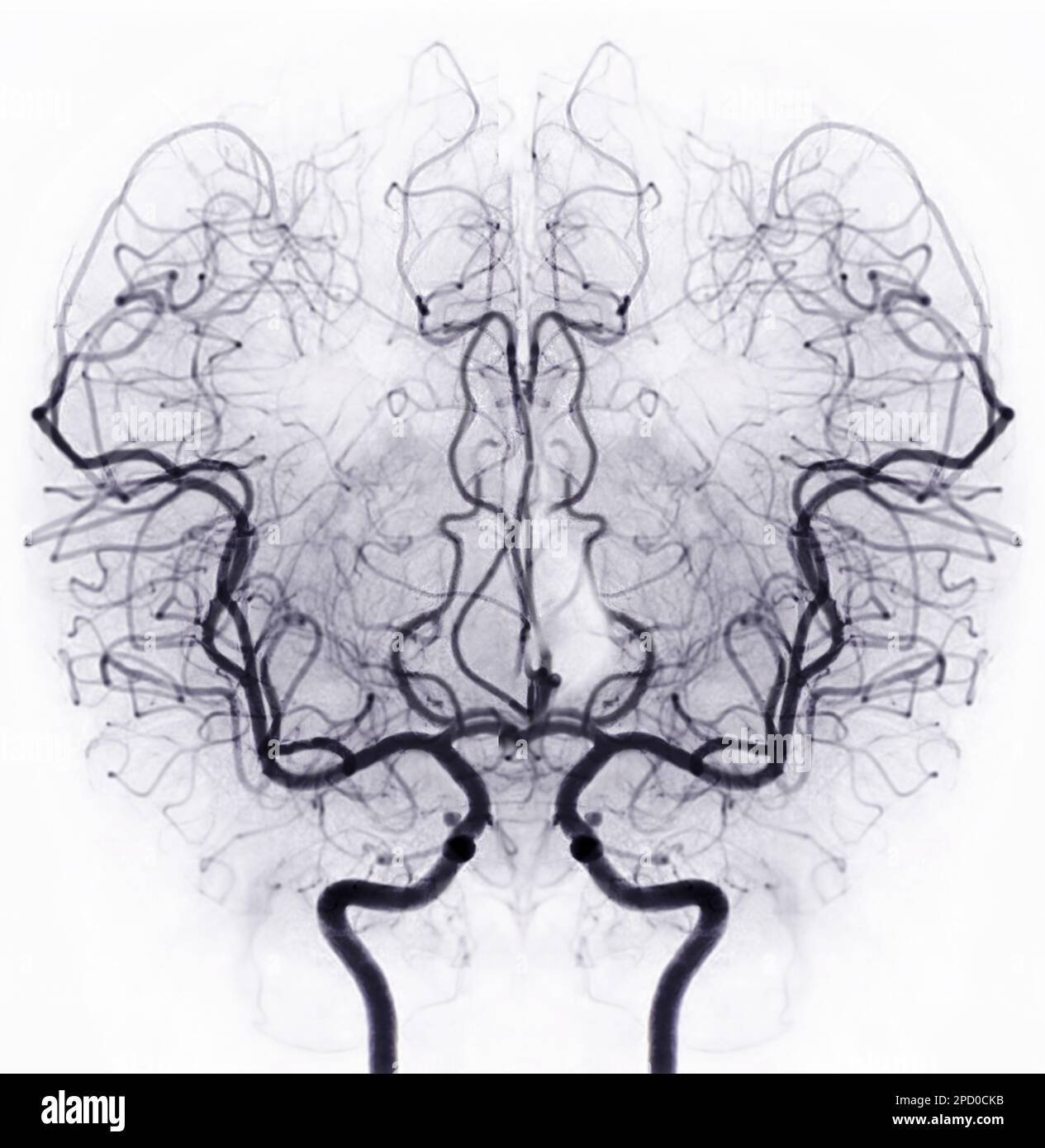 Cerebral angiography image from Fluoroscopy in intervention radiology ...