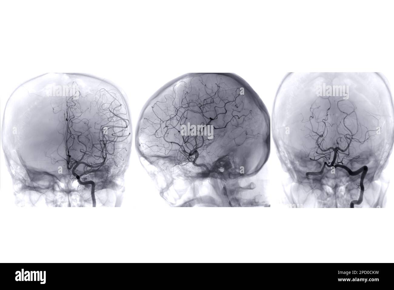 Cerebral angiography image from Fluoroscopy in intervention radiology ...
