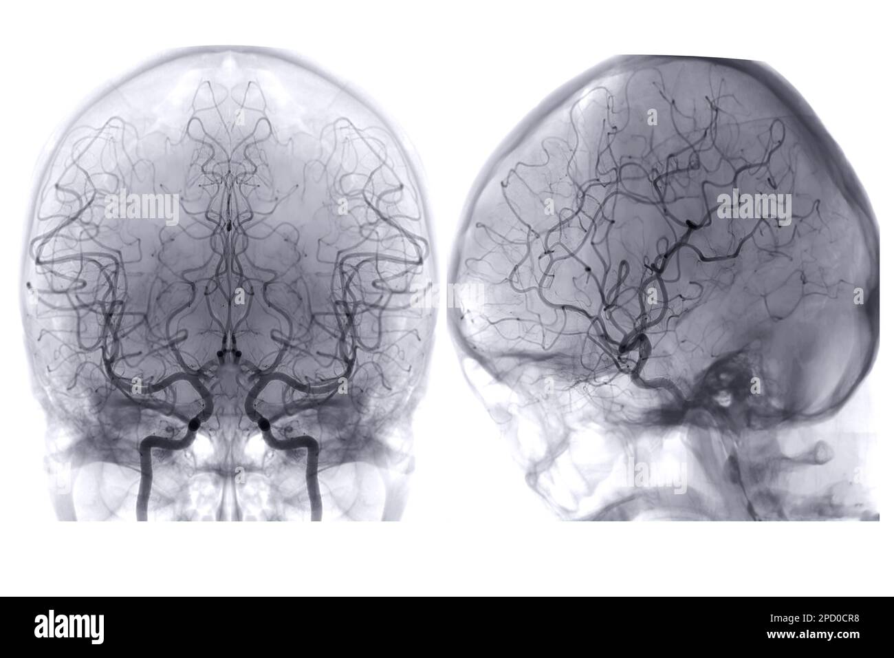 Cerebral angiography image from Fluoroscopy in intervention radiology ...