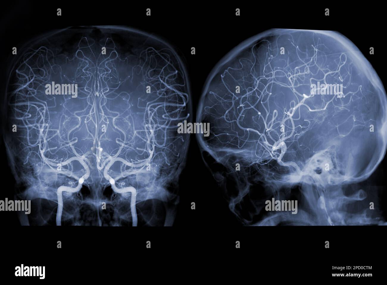 Cerebral angiography image from Fluoroscopy in intervention radiology ...