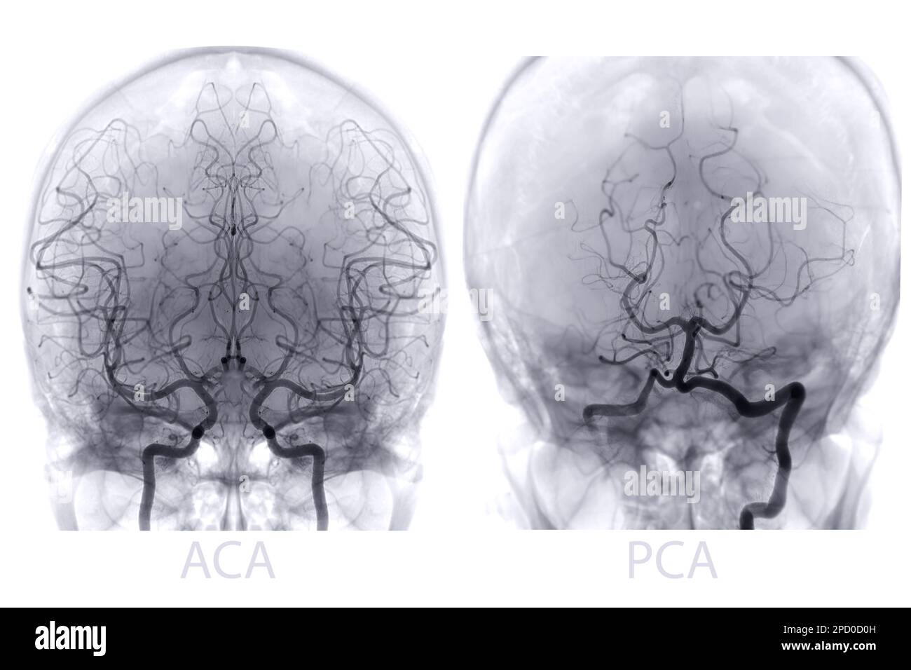 Cerebral angiography image from Fluoroscopy in intervention radiology ...