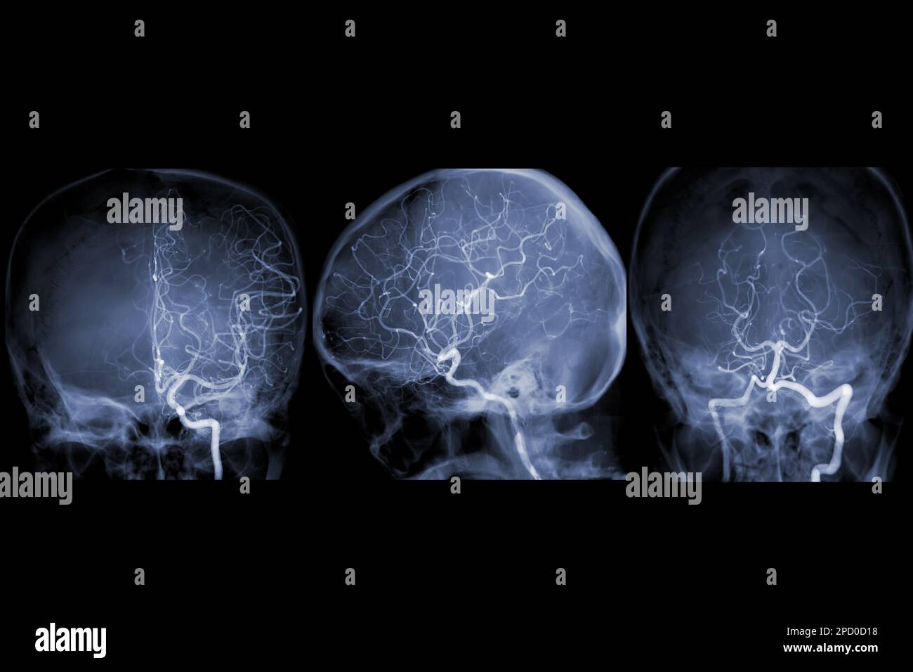 Cerebral angiography image from Fluoroscopy in intervention radiology ...