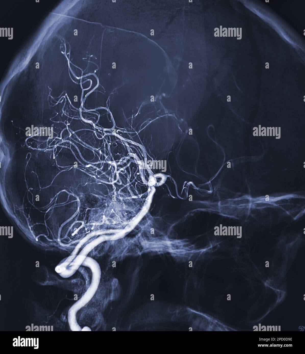 Cerebral angiography image from Fluoroscopy in intervention radiology ...