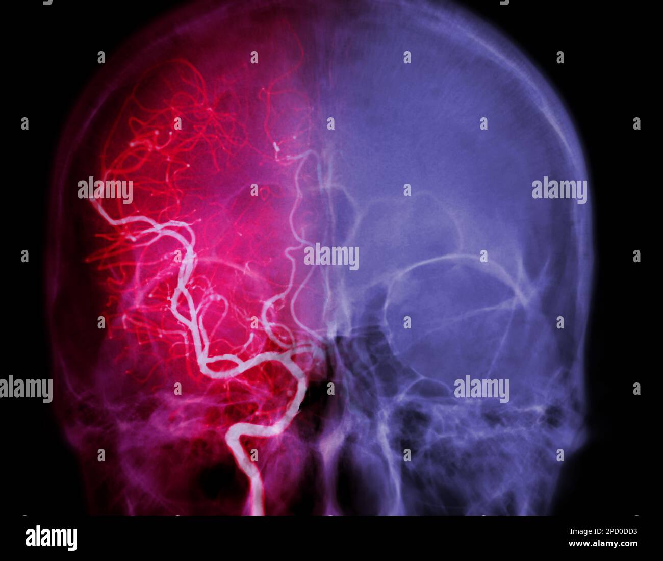 Cerebral angiography image from Fluoroscopy in intervention radiology ...