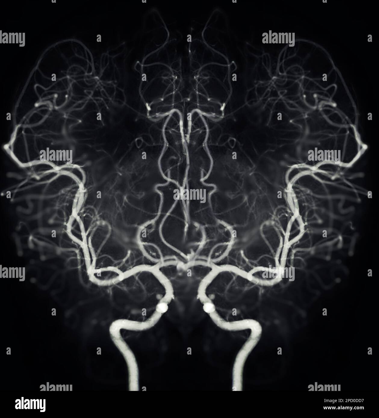 Cerebral angiography image from Fluoroscopy in intervention radiology ...