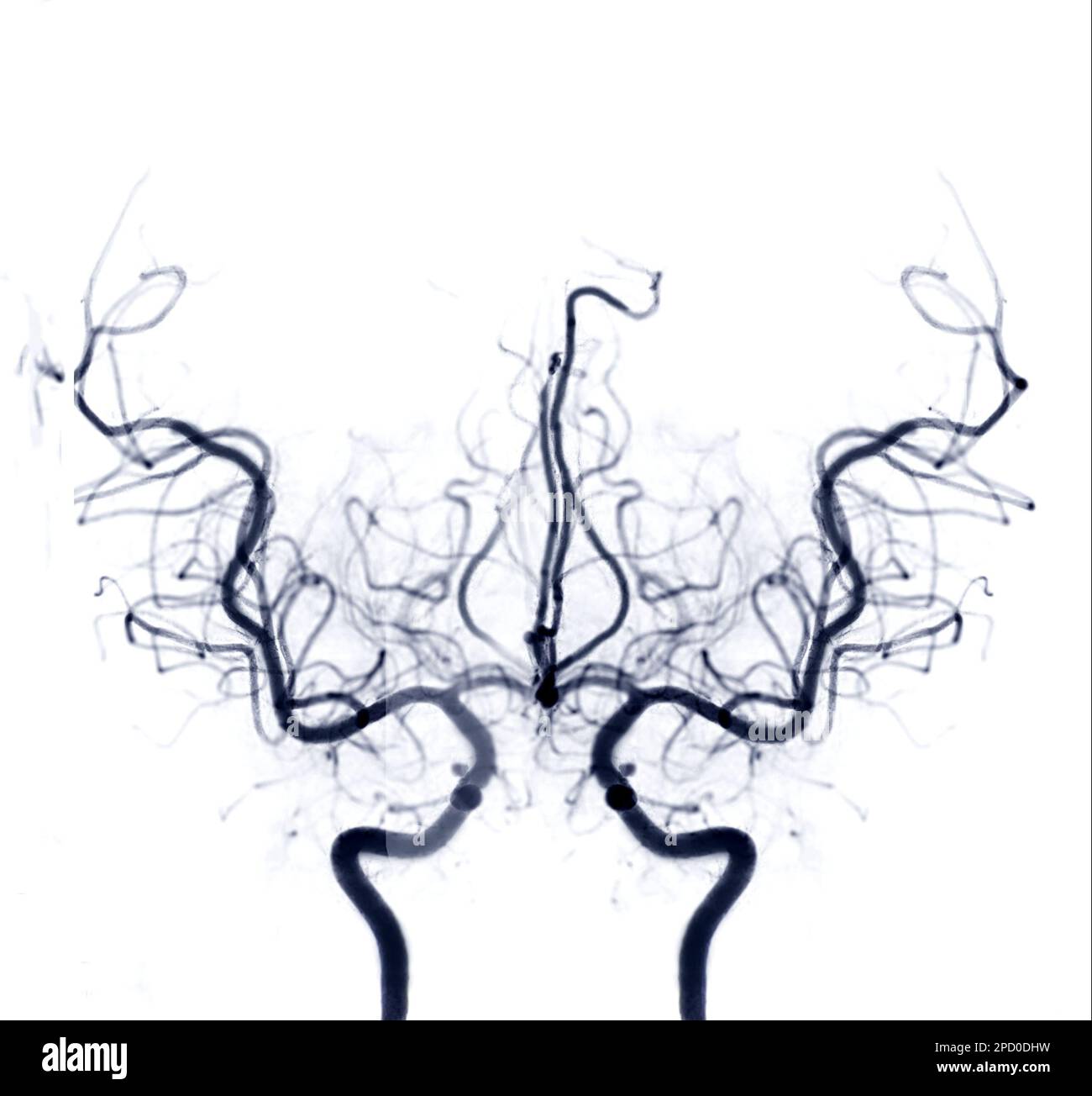 Cerebral angiography image from Fluoroscopy in intervention radiology ...