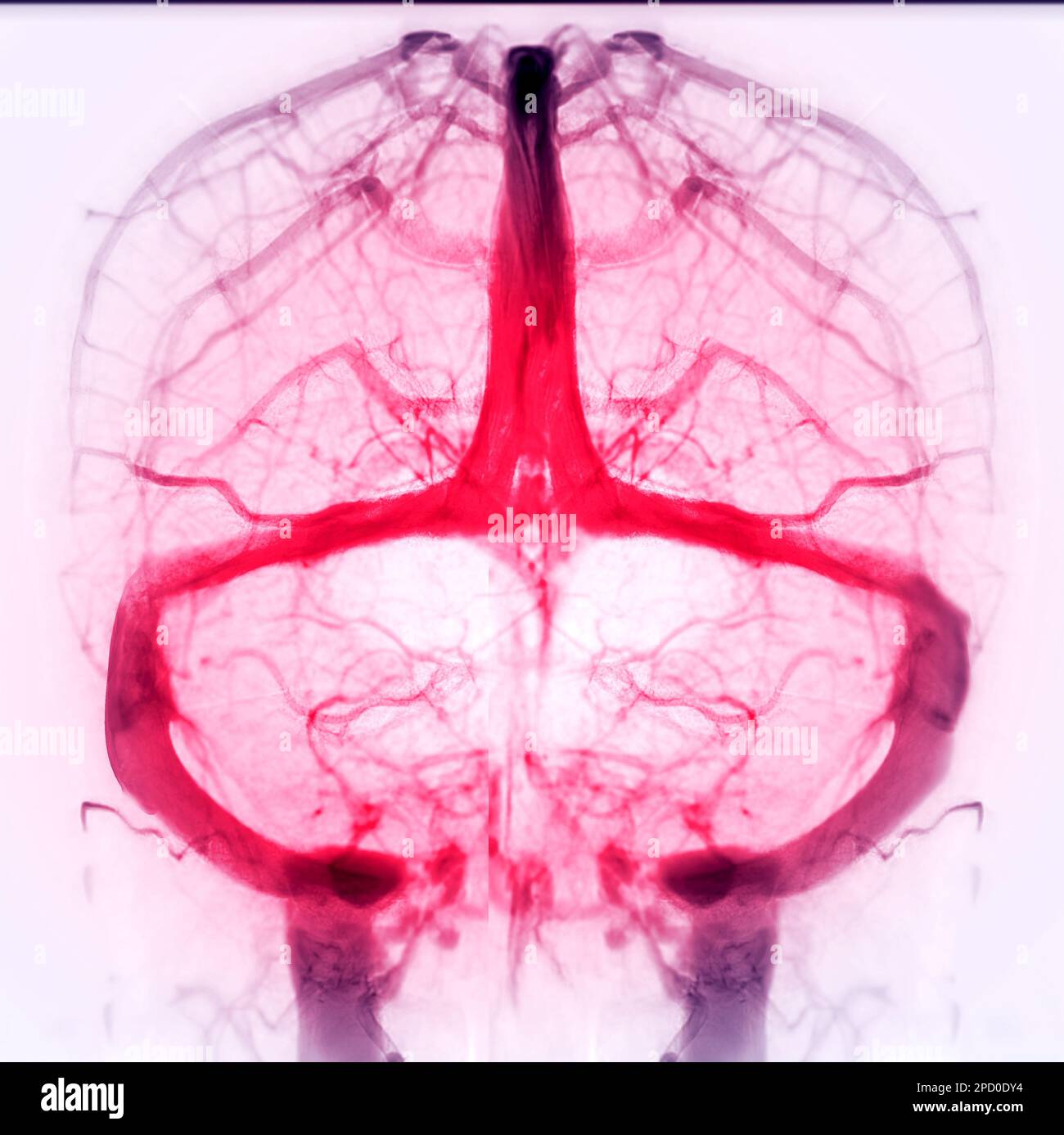 Cerebral Venograpgy for diagnosisi Cerebral Venous Thrombosis Stock ...