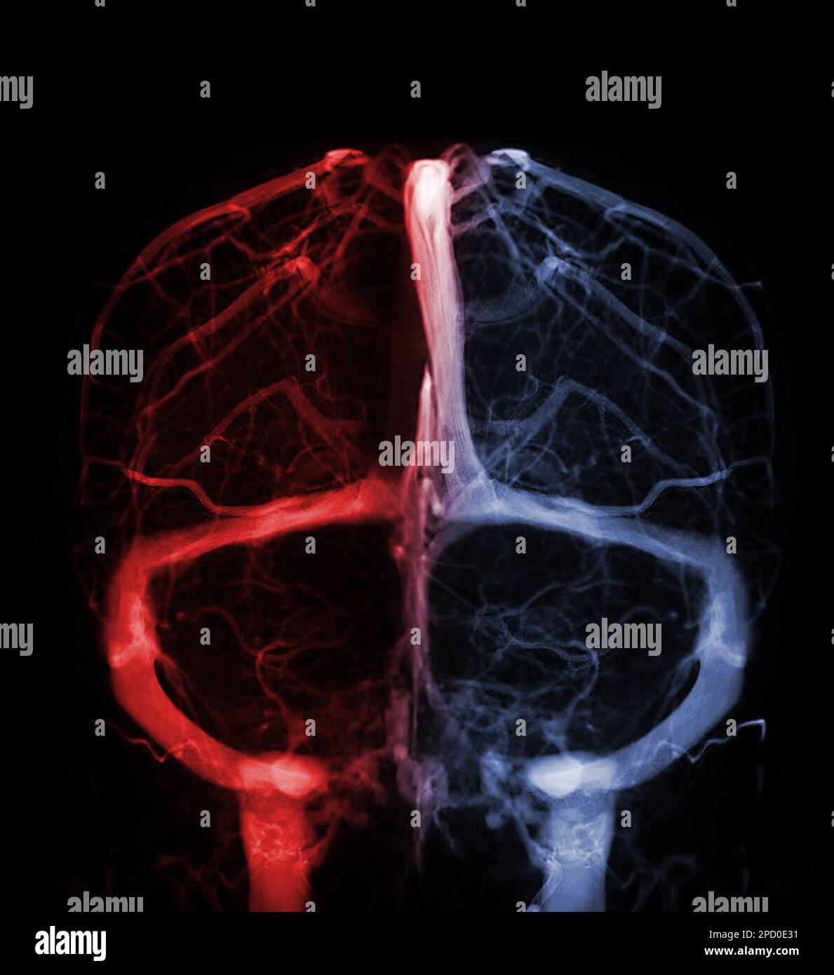 Cerebral Venograpgy for diagnosisi Cerebral Venous Thrombosis Stock ...