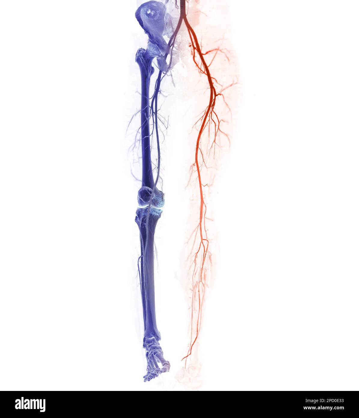 Femoral angiogram hi-res stock photography and images - Alamy