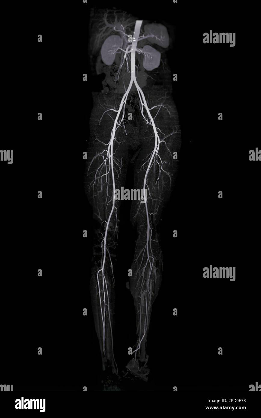 CTA femoral artery run off showing femoral artery for diagnostic Acute ...