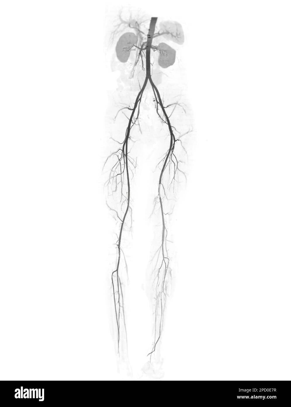 CTA femoral artery run off showing femoral artery for diagnostic Acute ...