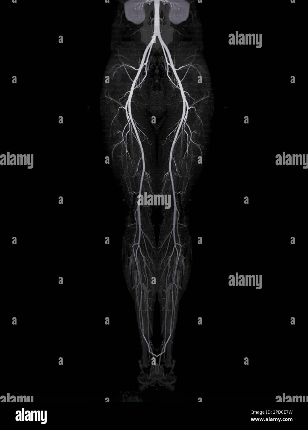 CTA femoral artery run off showing femoral artery for diagnostic Acute ...