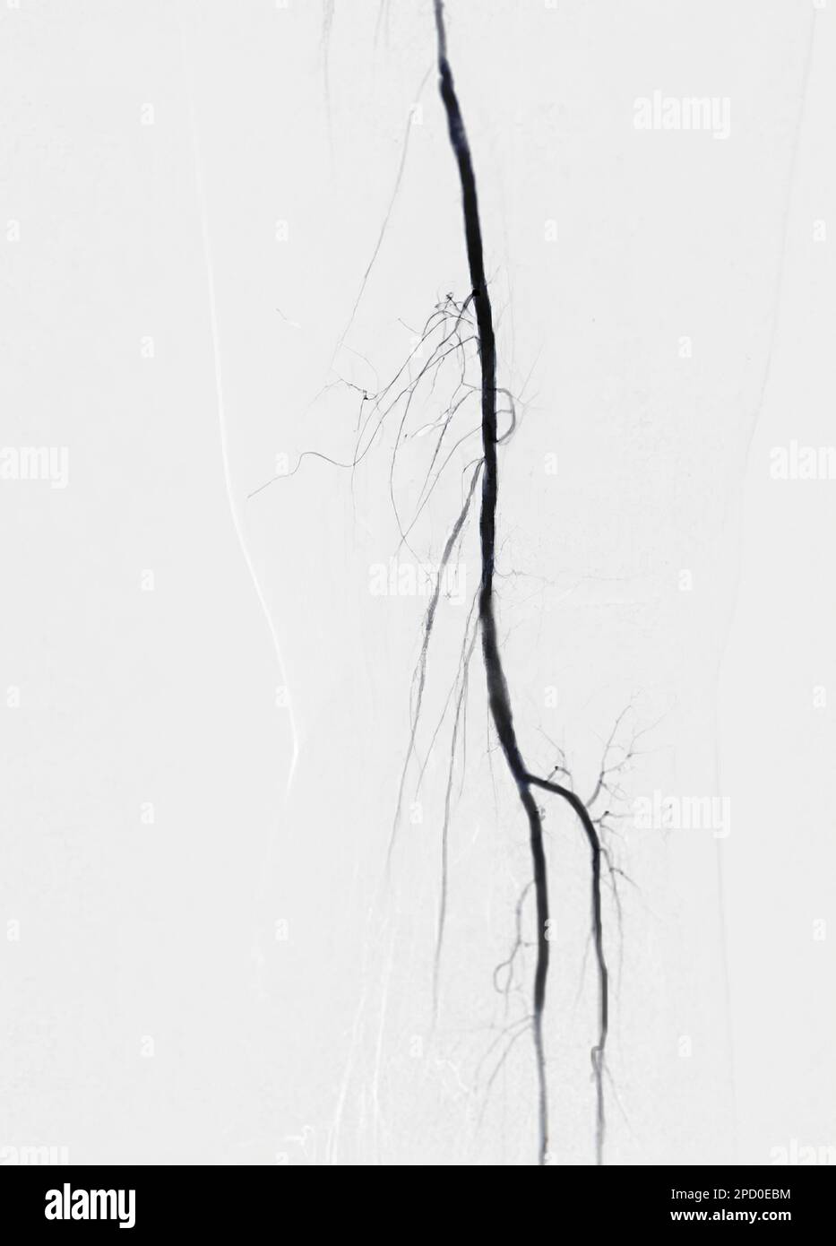 Femoral artery angiogram or angiography Stock Photo - Alamy