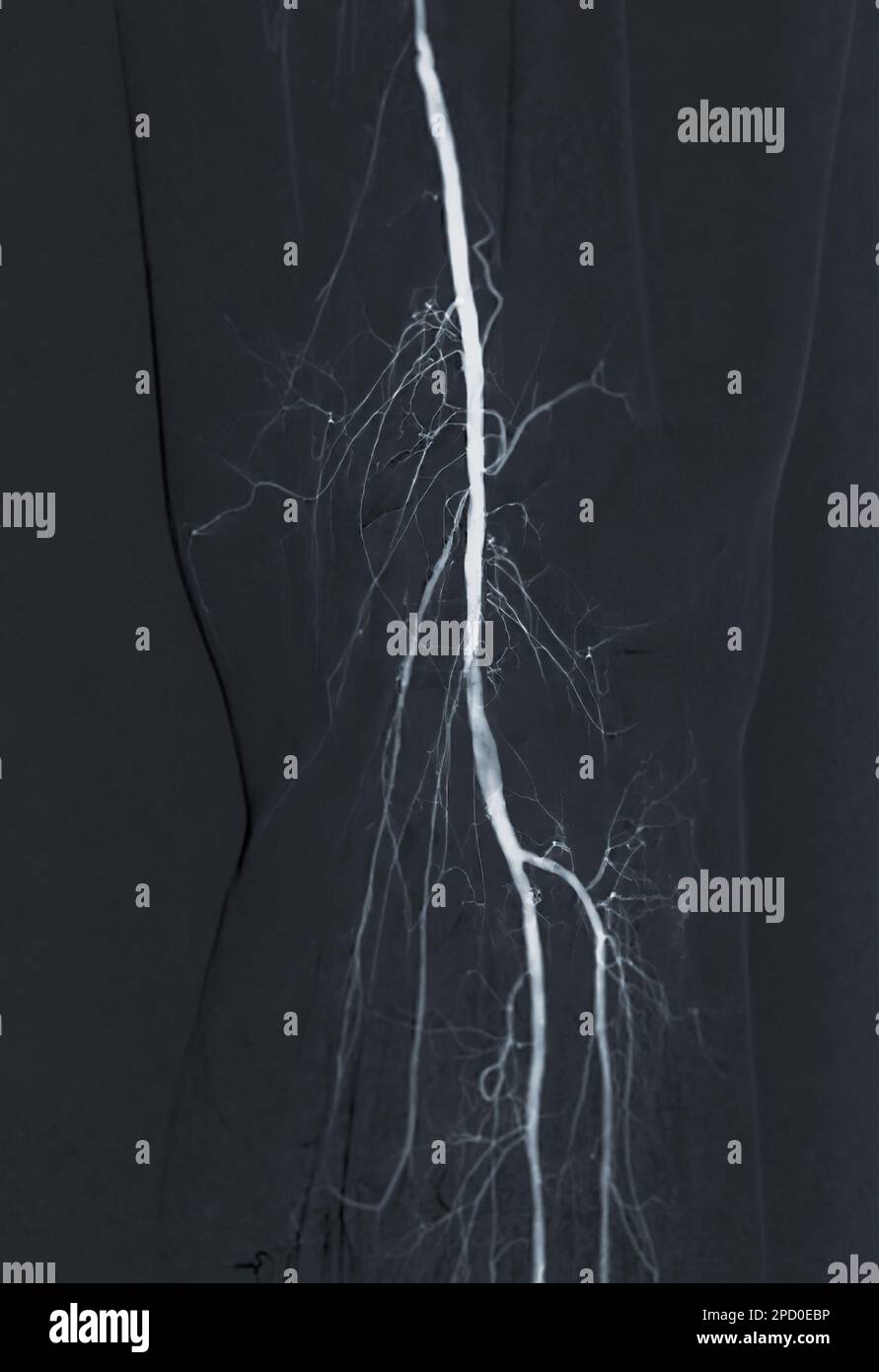 Femoral artery angiogram or angiography Stock Photo - Alamy