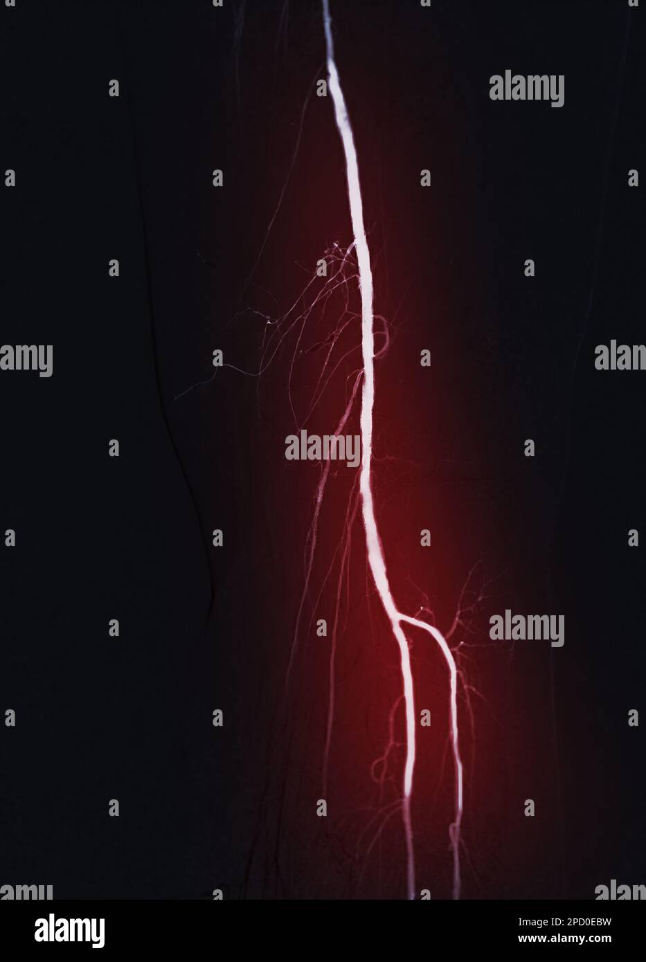 Femoral artery angiogram or angiography Stock Photo - Alamy