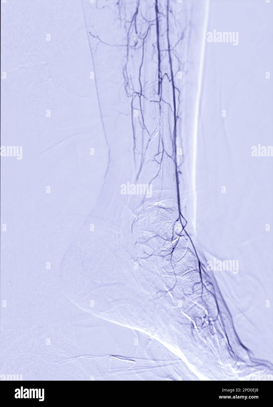 Femoral artery angiogram or angiography at lower extremity area Stock ...