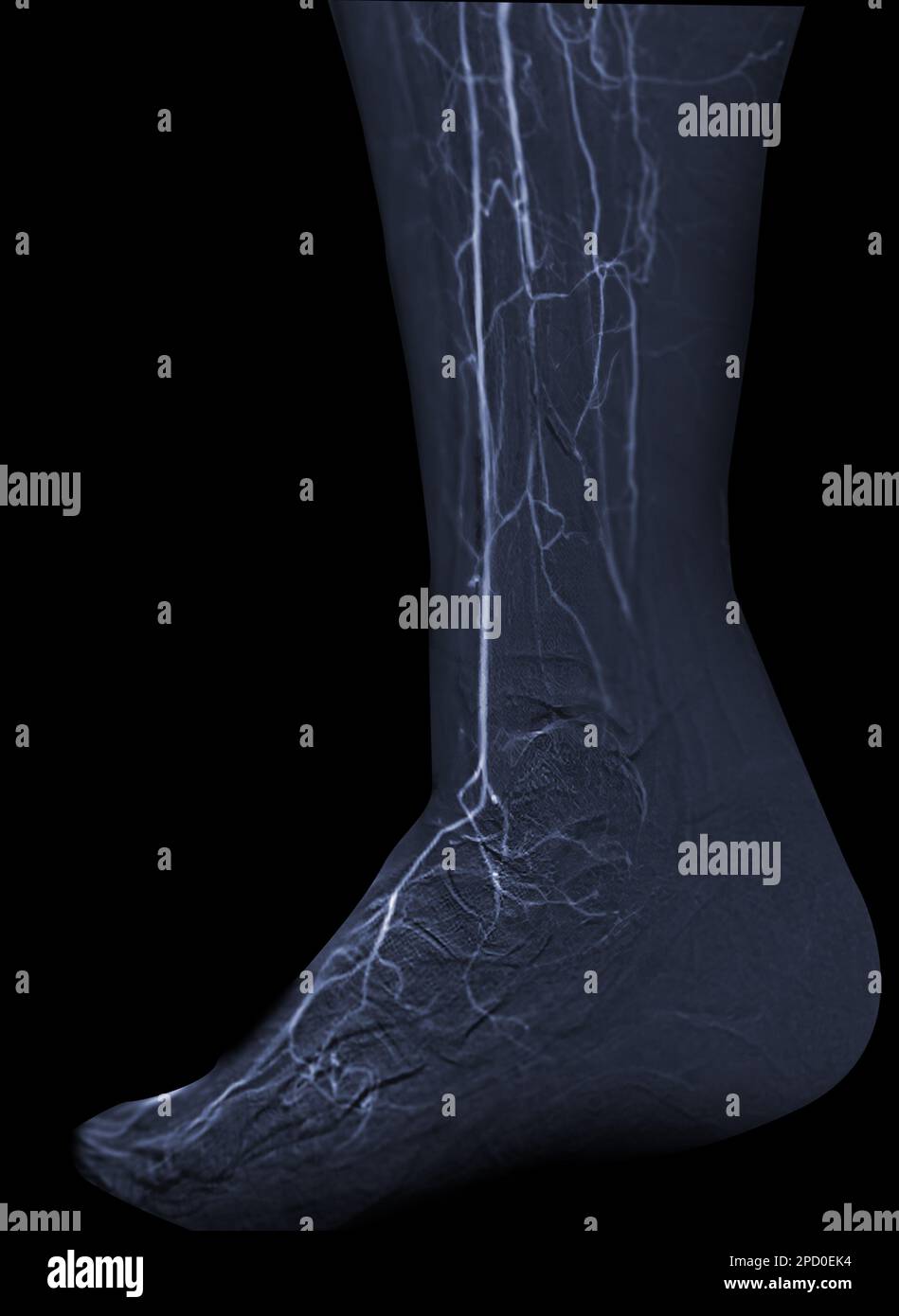 Femoral artery angiogram or angiography at lower extremity area Stock ...