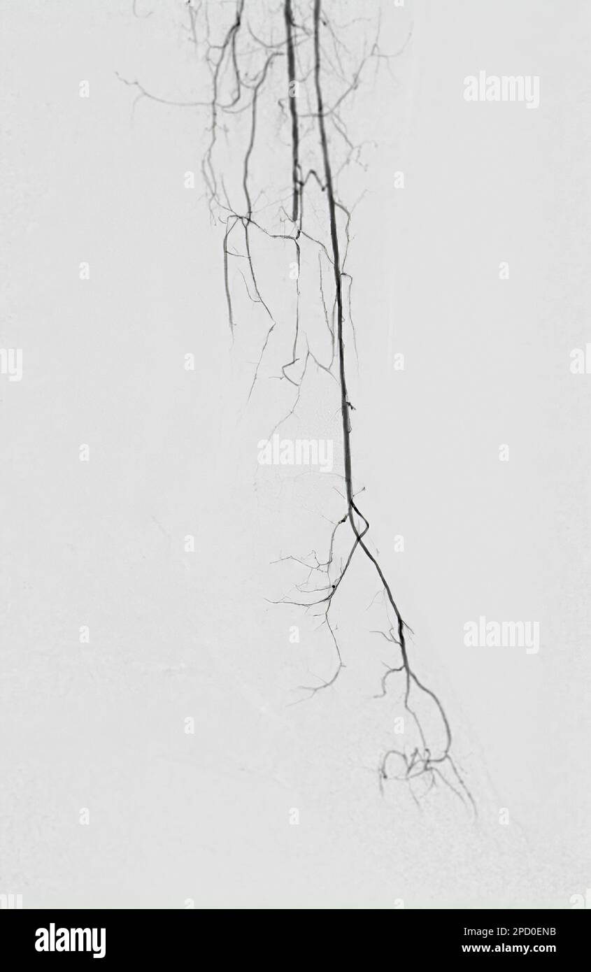 Femoral artery angiogram or angiography at lower extremity area Stock ...