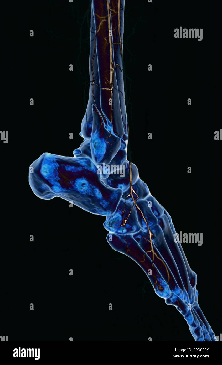 Femoral artery angiogram or angiography at lower extremity area Stock ...